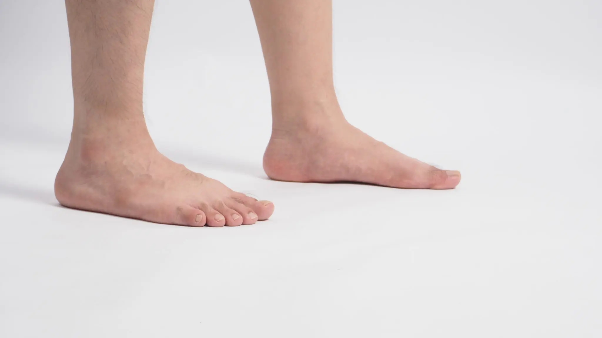 Le pied plat : symptômes et traitements