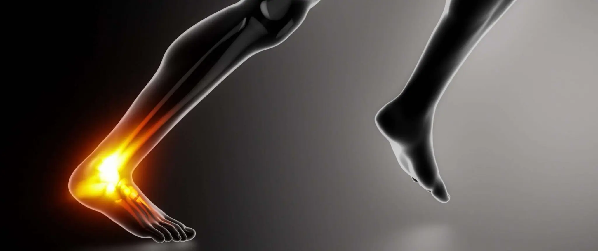 La tendinite au tendon d’Achille | PiedRéseau